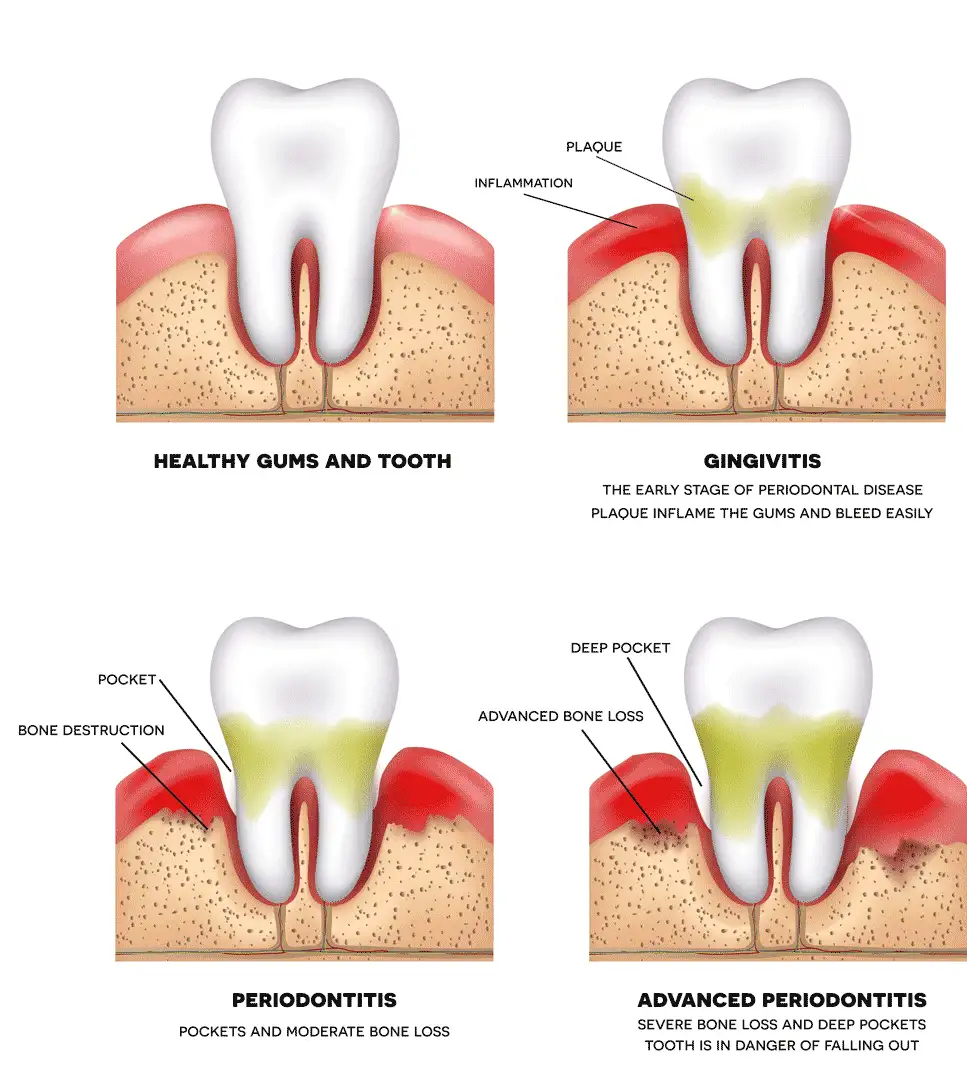 Gingivitis Tablet - Lasting Effect Consumer Pharma